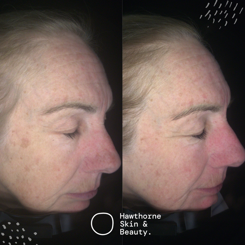 IPL Pigment Removal – Hawthorne Skin & Beauty